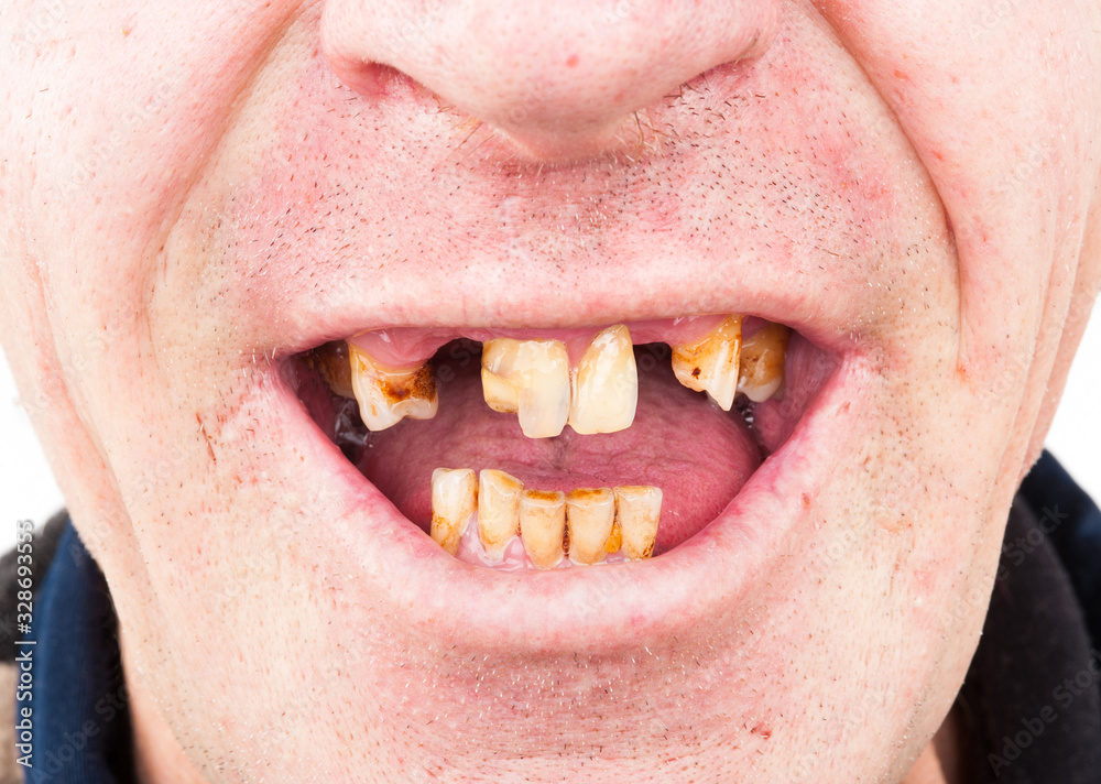 Bad teeth smoker. Missing and decaying teeth. Caries Stock Photo ...