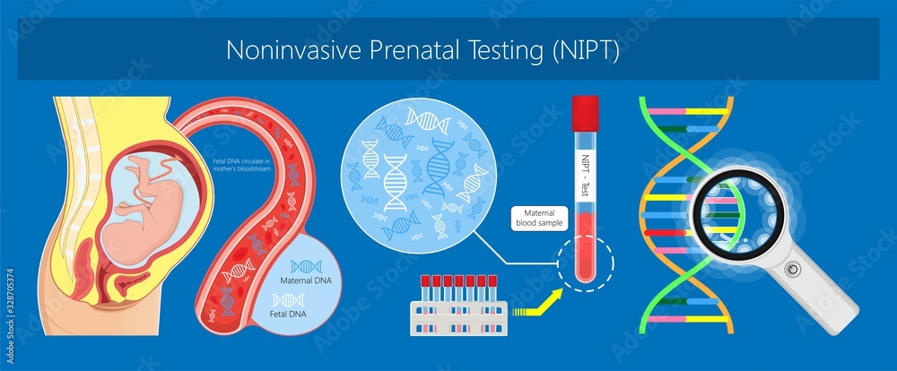 Vetor do Stock: Noninvasive prenatal testing NIPT screening genetic ...