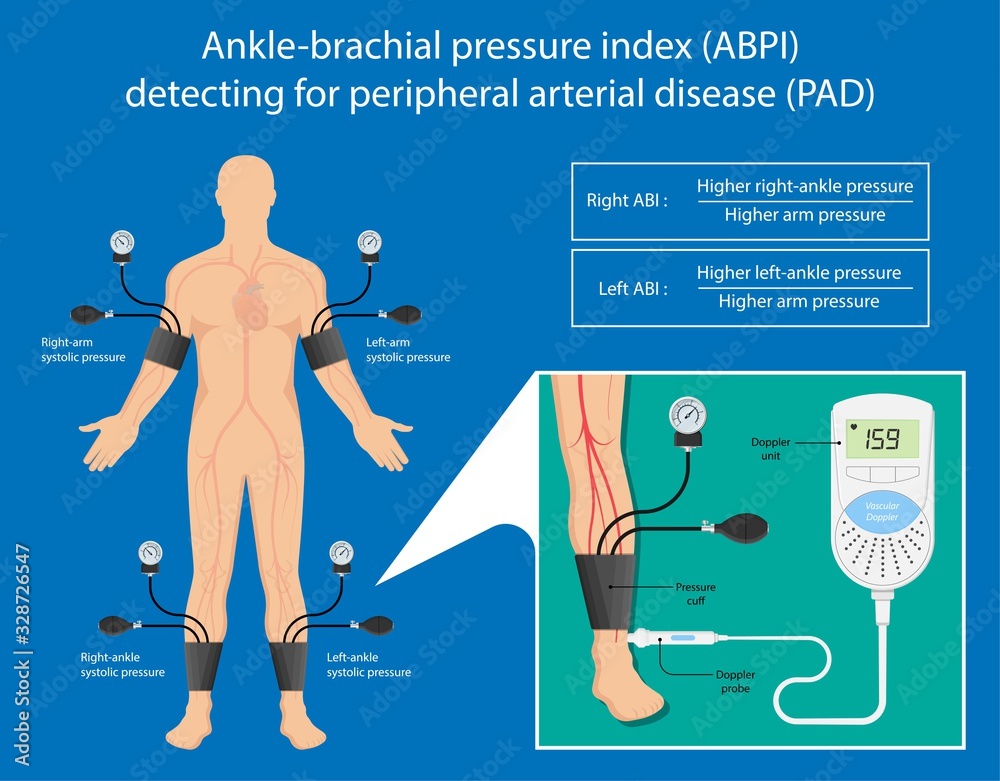 Vecteur Stock Peripheral artery disease ankle brachial index ABI test ...