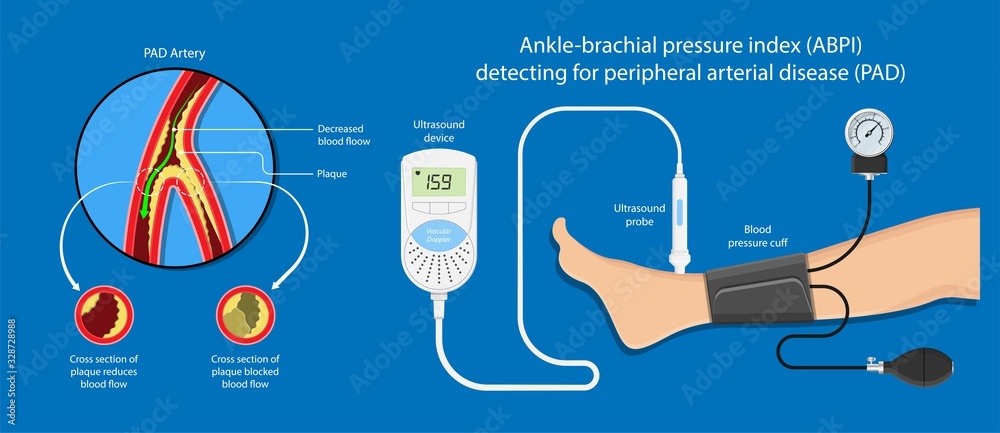 Peripheral artery disease ankle brachial index ABI test limb ischemia ...