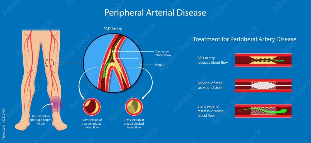 Peripheral artery disease ankle brachial index ABI test limb ischemia ...