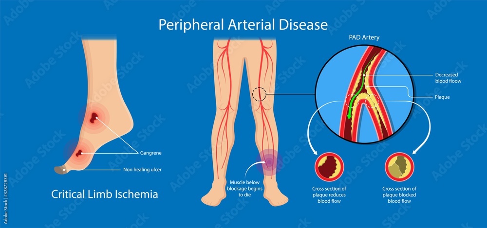 Peripheral artery disease ankle brachial index ABI test limb ischemia ...