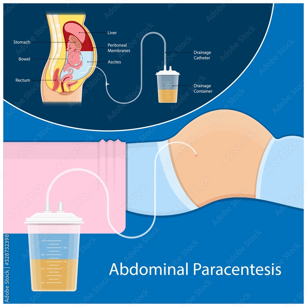 Ascites Paracentesis medical procedure diagnostic abdominal bacteria ...