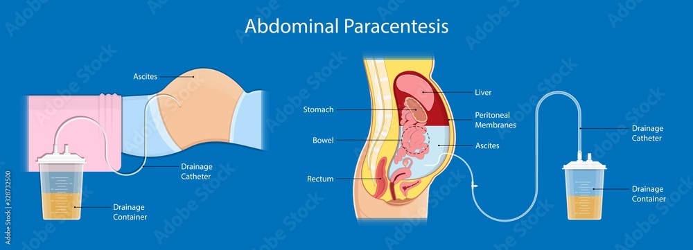 Ascites Paracentesis medical procedure diagnostic abdominal bacteria ...