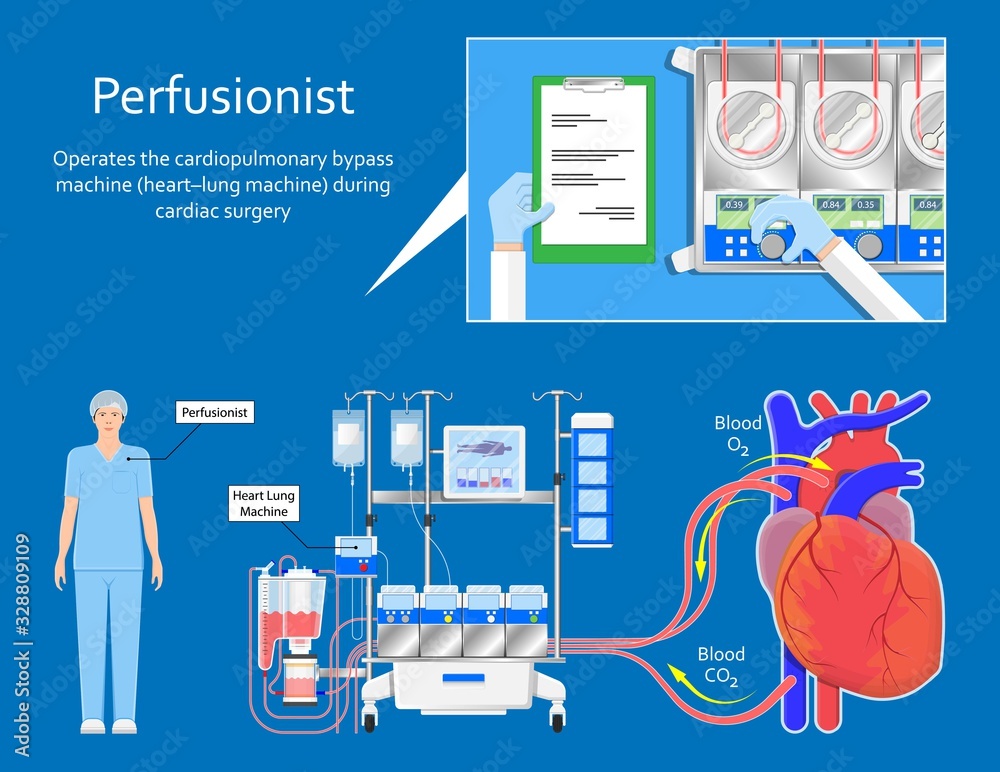 Vektorová grafika „Cardiopulmonary bypass heart lung machine coronary ...