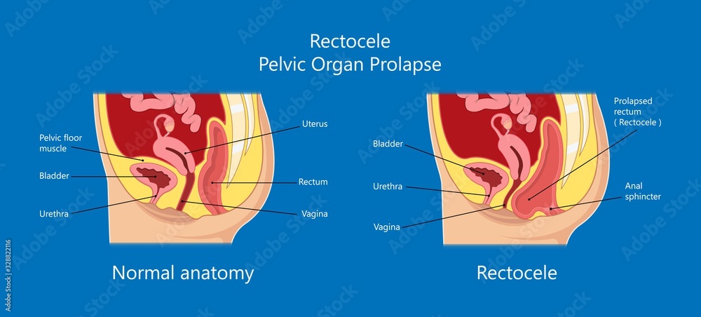 Pelvic Floor Prolapse Type Uterine Uterus Biofeedback Pelvic Floor