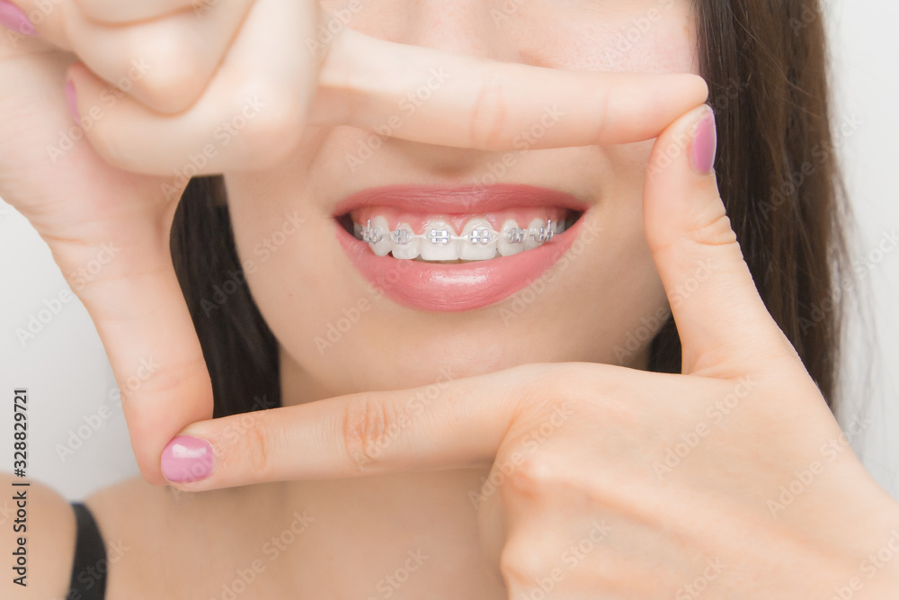 Dental braces in happy womans mouths through the frame. Brackets on the ...