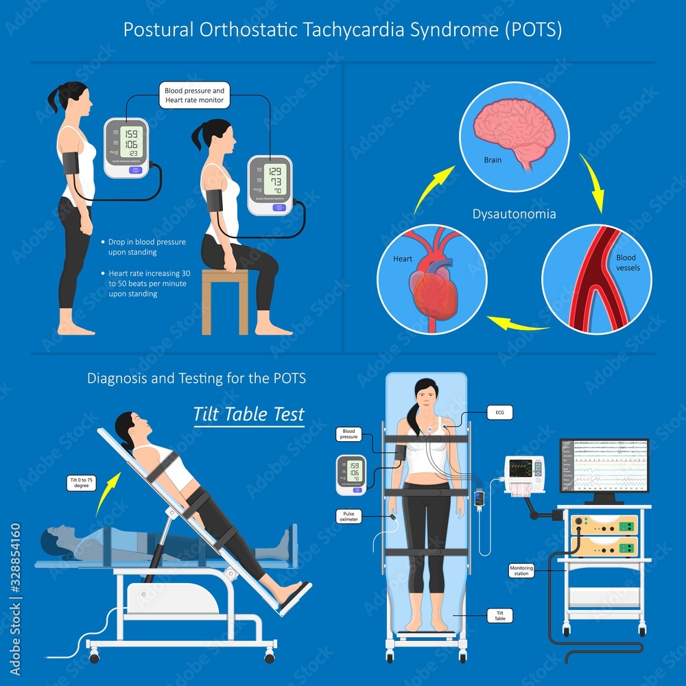 Póster Postural Orthostatic Tachycardia Syndrome POTS intolerance tilt ...