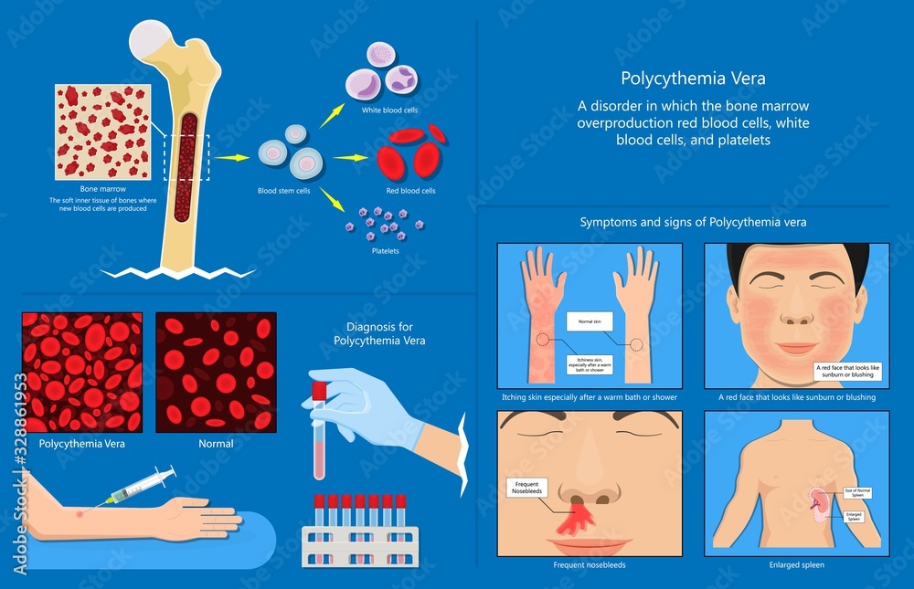 Polycythemia vera PV blood clots cancer bone marrow diagnostic complete ...