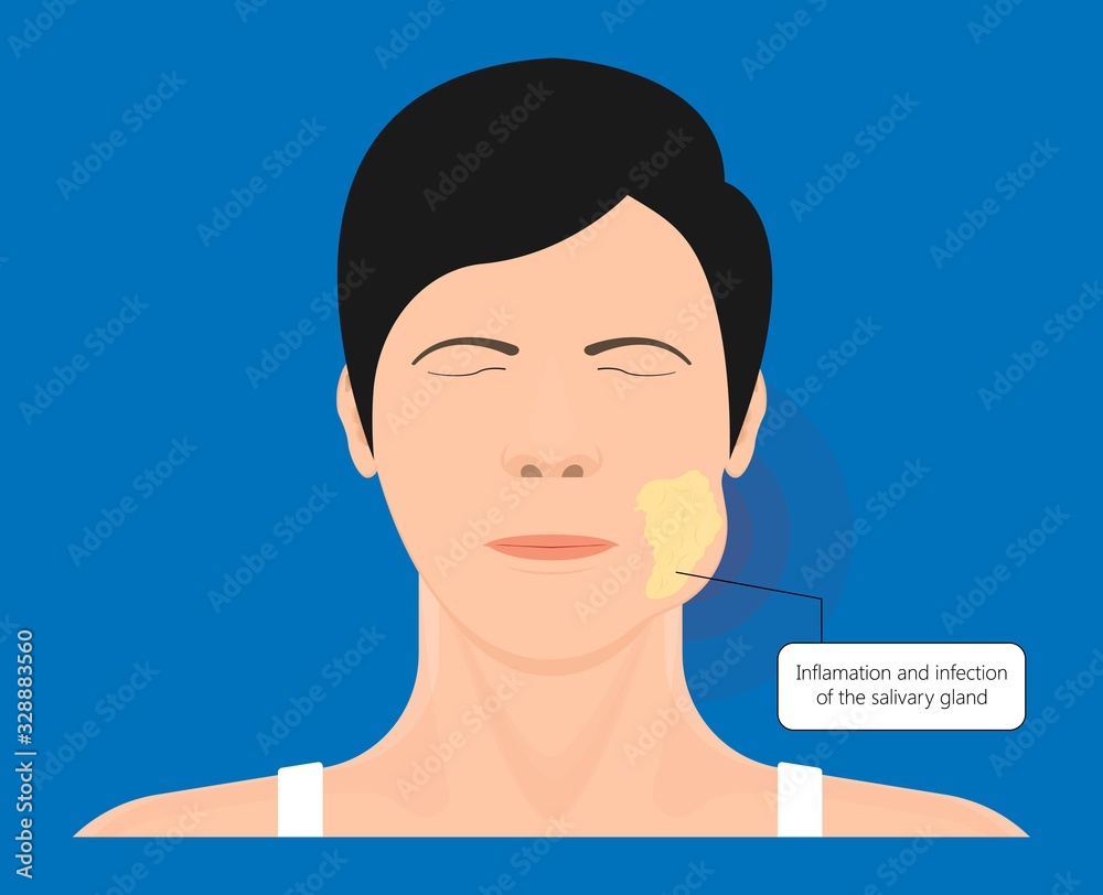 Parotid gland Sialadenitis bacterial infection Sialolithiasis blockage ...