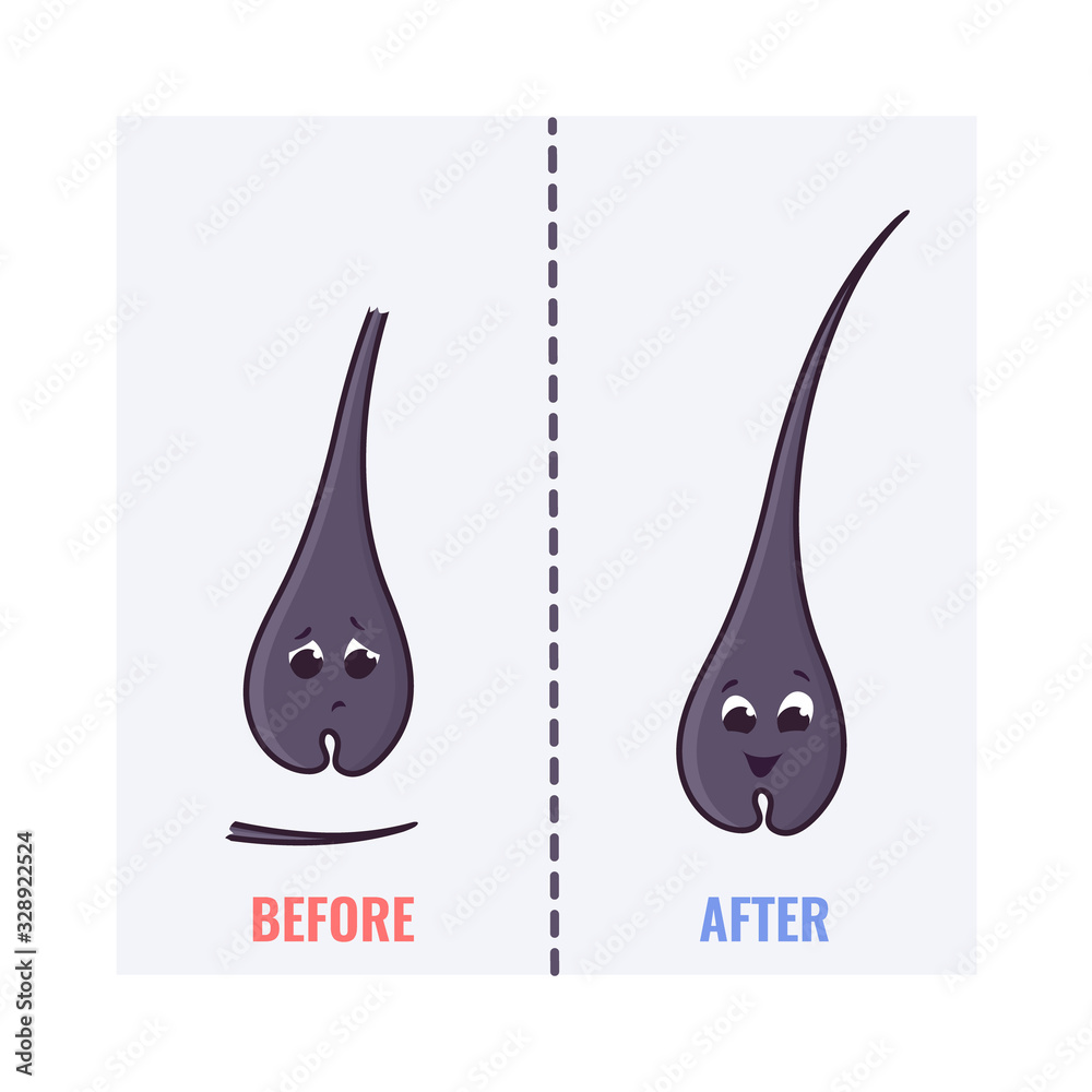 Healthy vs damaged hair follicle cartoon characters in good and bad ...