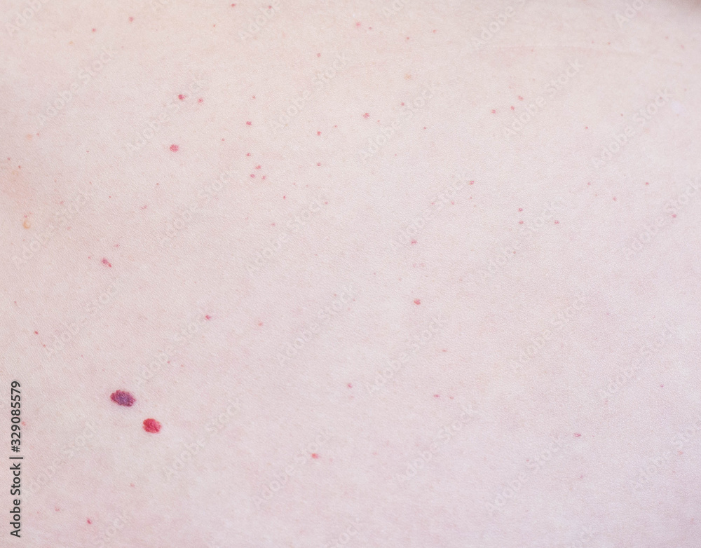 Little Red Moles On Skin