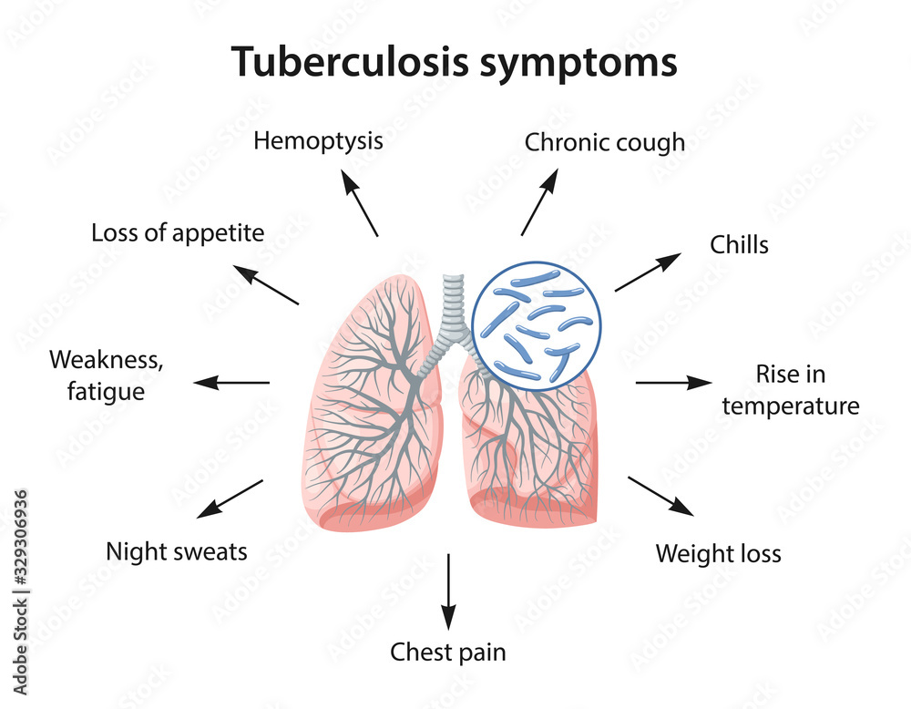 Tubercle Tuberculosis