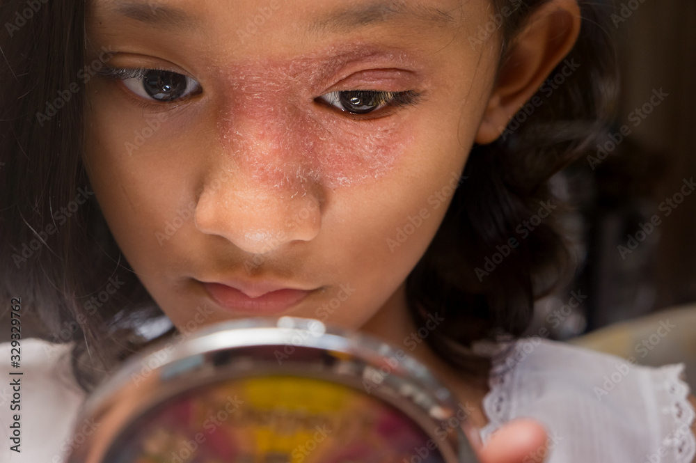 Southeast Asian ethnicity teenage girl with circular shape skin rash on ...