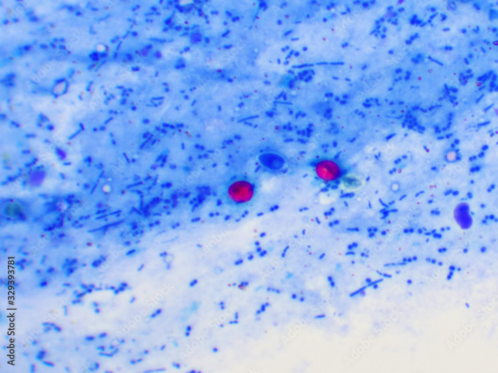 Cryptosporidium parvum protozoa positive (red sphere shape) in human ...