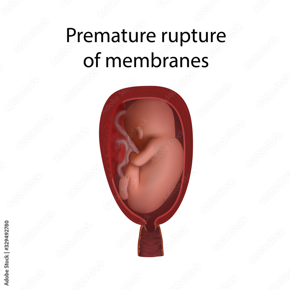 Premature rupture of membranes. Cervical weakness. Fetus in uterus ...