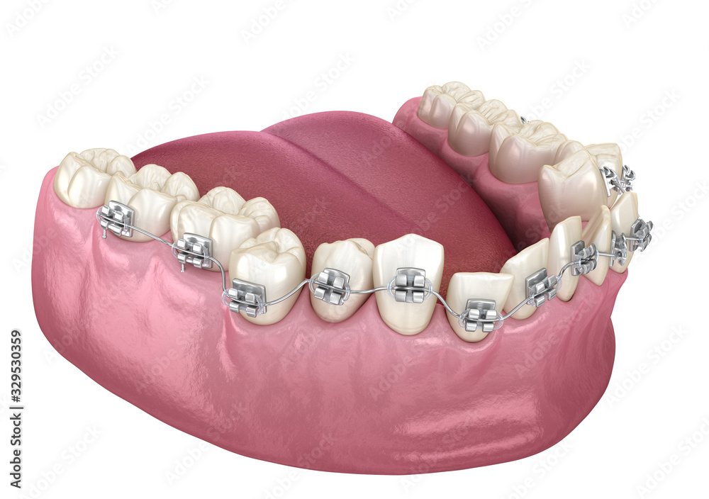 Abnormal teeth position and Clear braces tretament. Medically accurate ...
