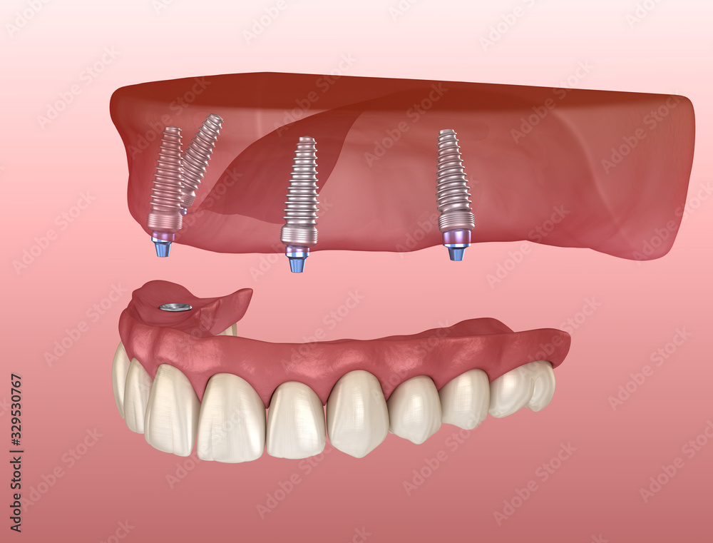 Maxillary prosthesis with gum All on 4 system supported by implants ...