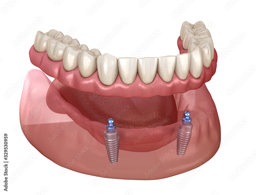 Mandibular removable prosthesis All on 2 system supported by implants ...