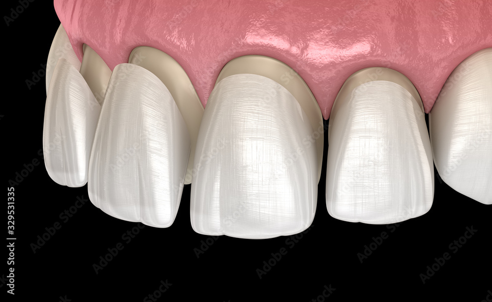 Veneer installation procedure over central incisor and lateral incisor ...