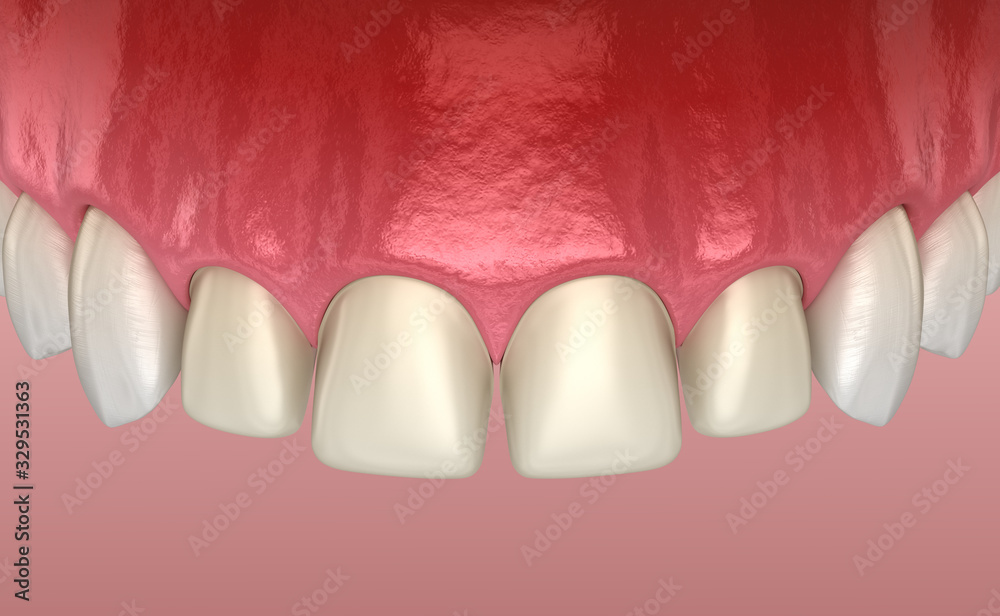 Teeth preparation for Veneer installation procedure over central ...