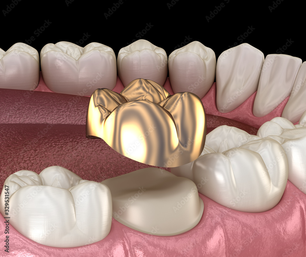 Golden crown molar tooth assembly process. Medically accurate 3D ...