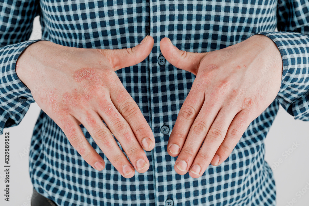 Man with sick hands, dry flaky skin on his hand with vulgar psoriasis ...