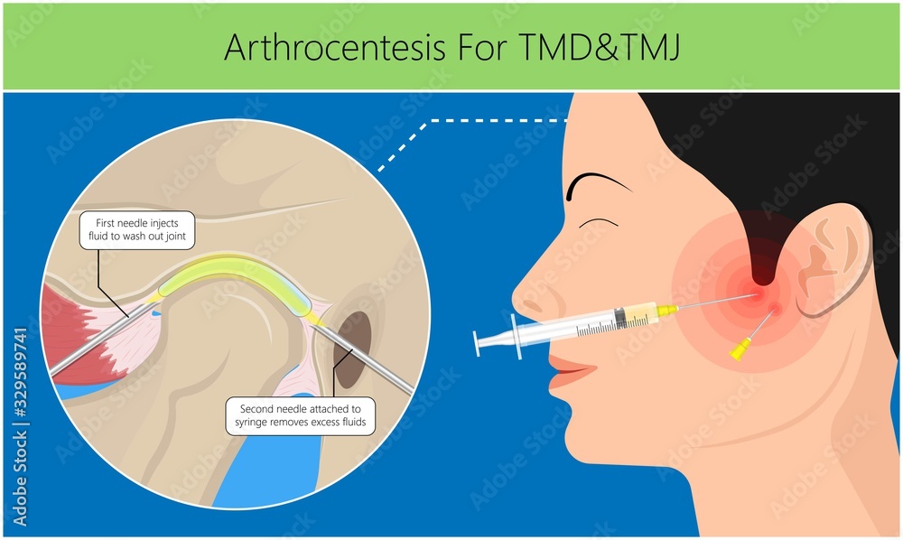 Temporomandibular Joint Disorders TMD TMJ treat pain displaced disc ...