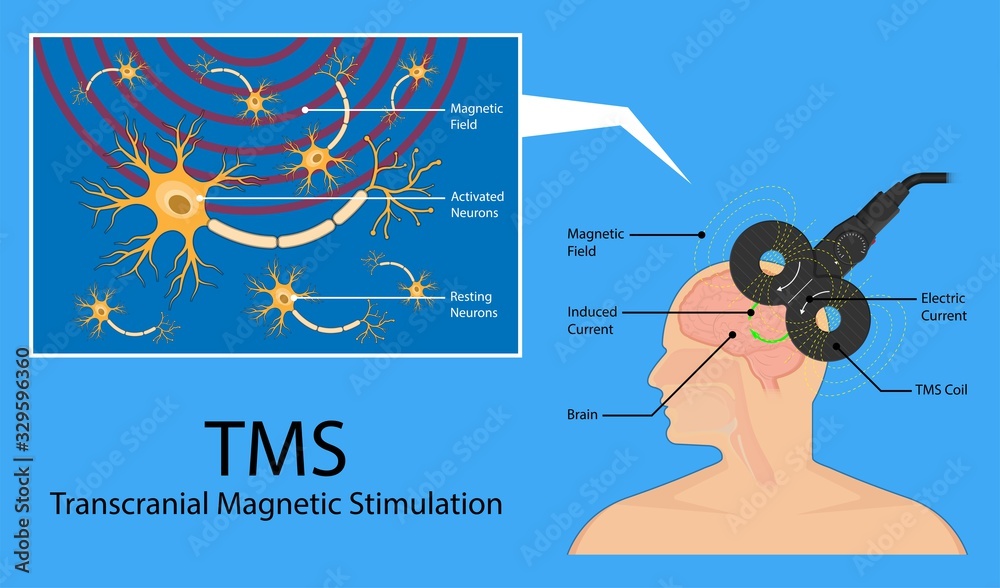 Transcranial magnetic stimulation TMS non invasive field obsessive ...