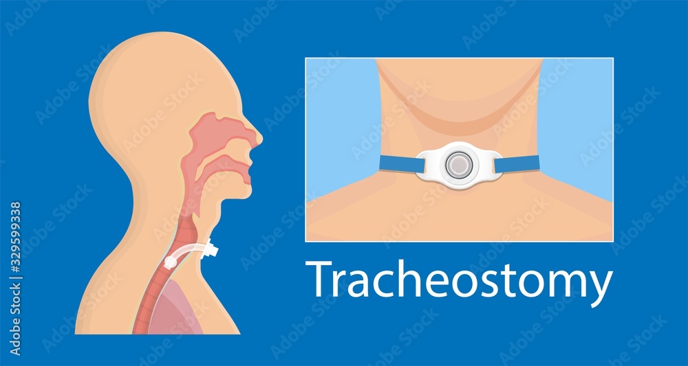 Tracheostomy surgical patient treatment procedure medical allergy neck ...