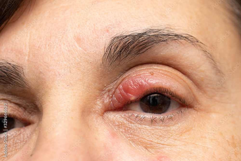 Upper Eyelid Infection