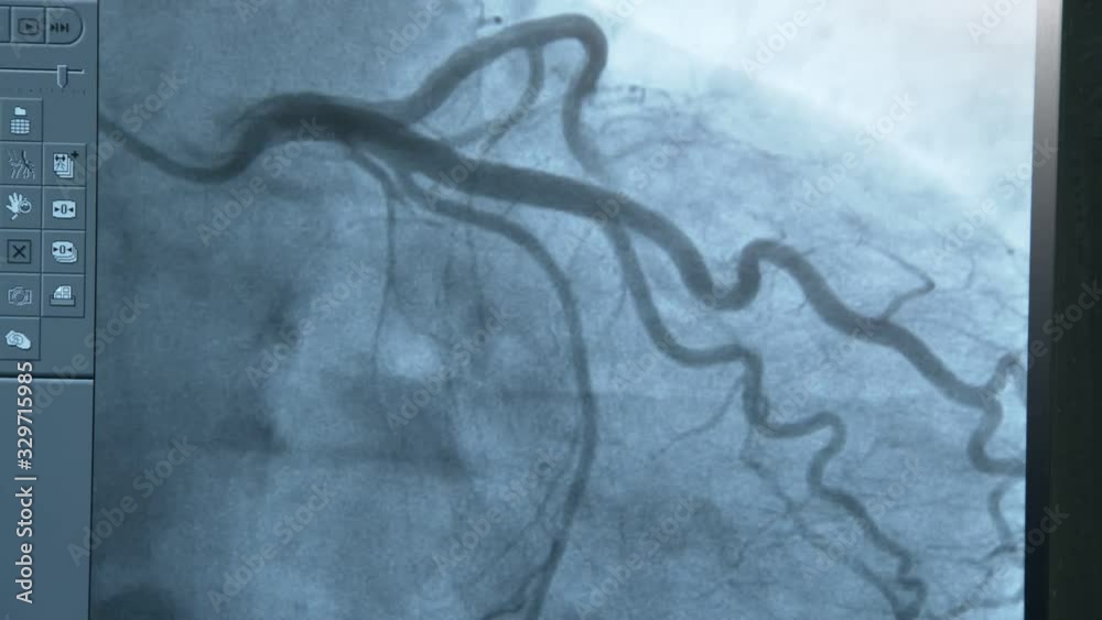 pulsing veins and arteries on display in angiography in clinic Stock ...