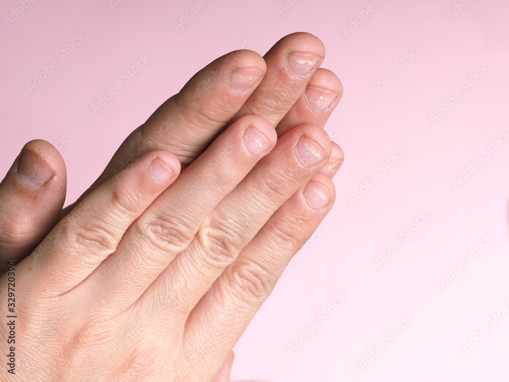 White spots on the nails of the male hand caused by a deficiency of ...
