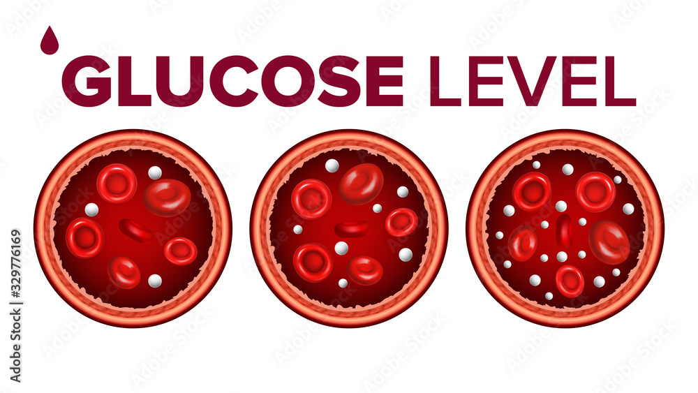 Glucose Sugar Level In Blood And Red Cells Vector. Hypoglycemia, Normal ...
