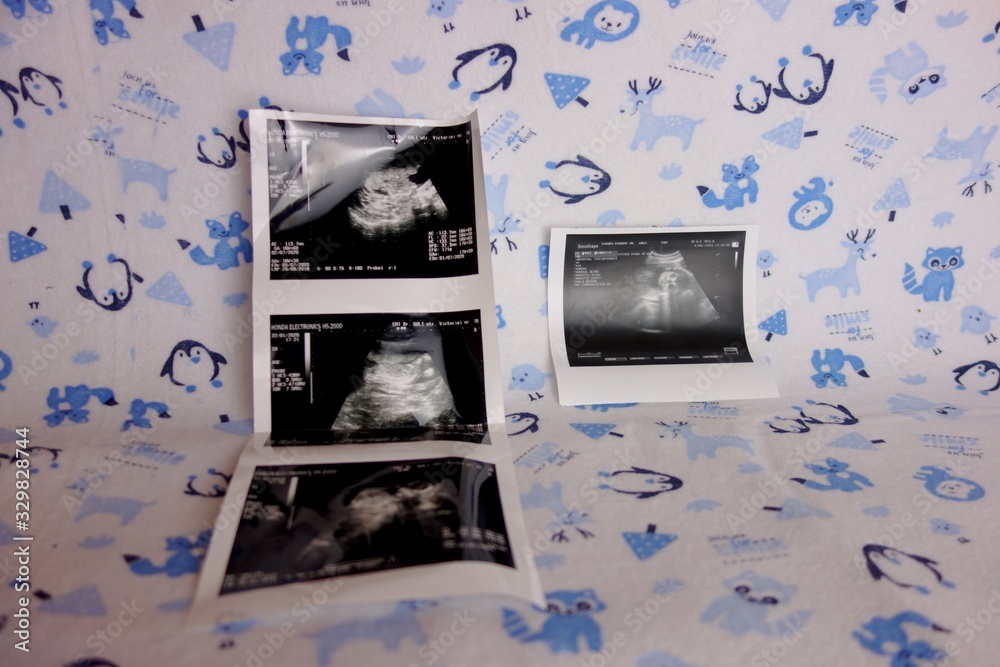 echography of baby girl first second trimester on blue and white ...
