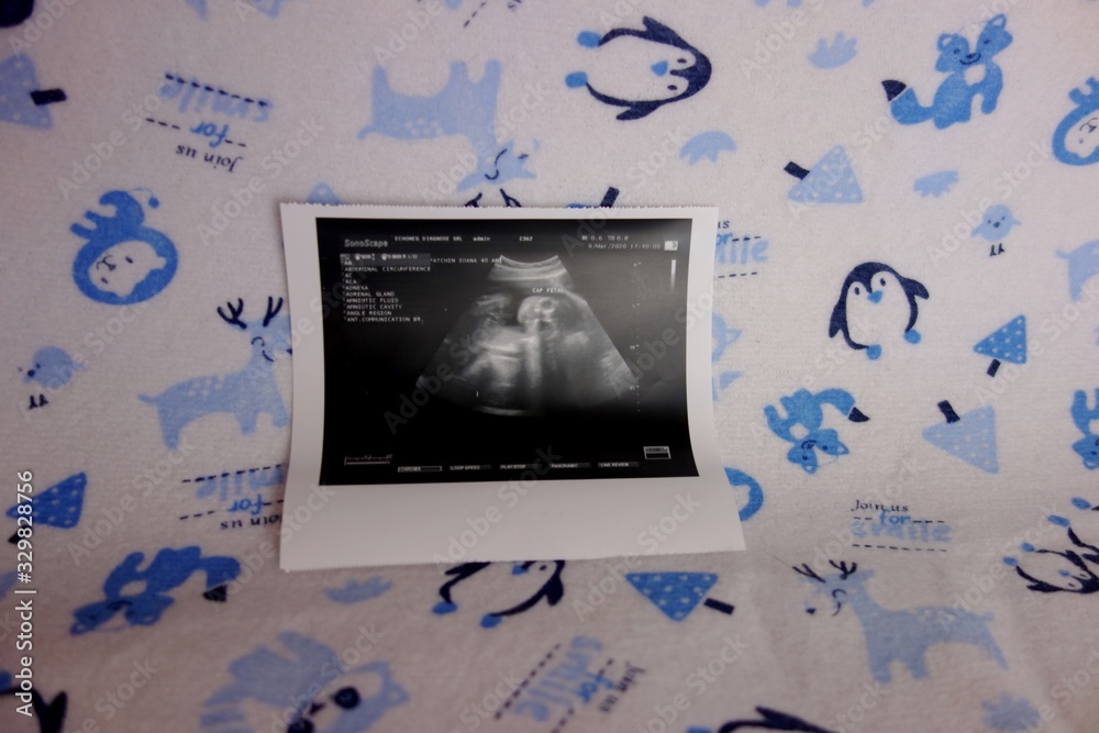 echography of baby girl first second trimester on blue and white ...