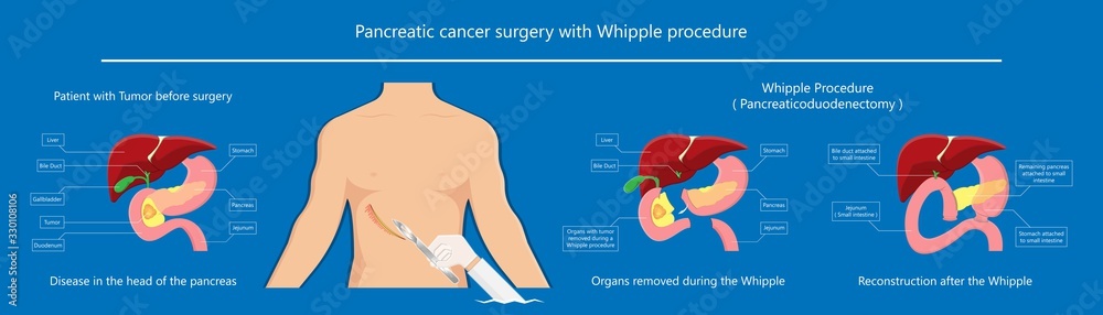 Whipple procedure pancreaticoduodenectomy Pancreatic cancer treatment ...