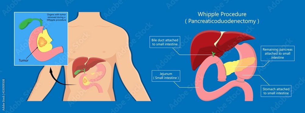 Whipple procedure pancreaticoduodenectomy Pancreatic cancer treatment ...