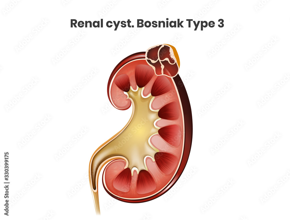 Renal cyst, Bosniak type 4. A complex cyst of the kidney. Renal cell ...