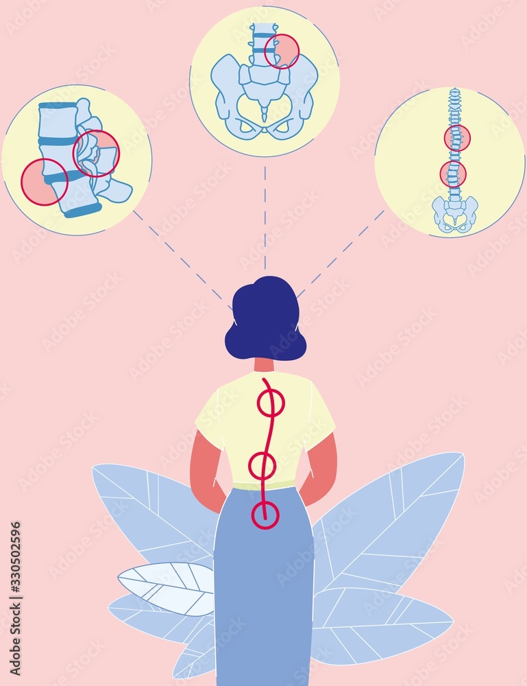 Cartoon Woman Character Standing with Back. Spinal Curvature ...
