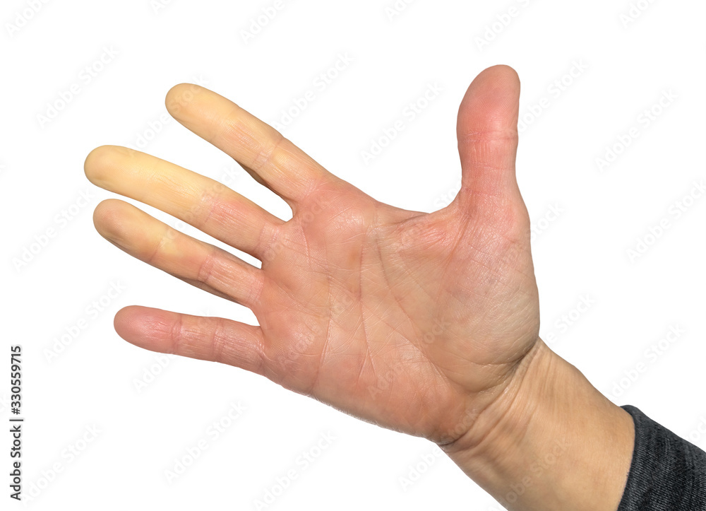 Hand with Raynaud's syndrome, Raynaud's phenomenon or Raynaud's ...