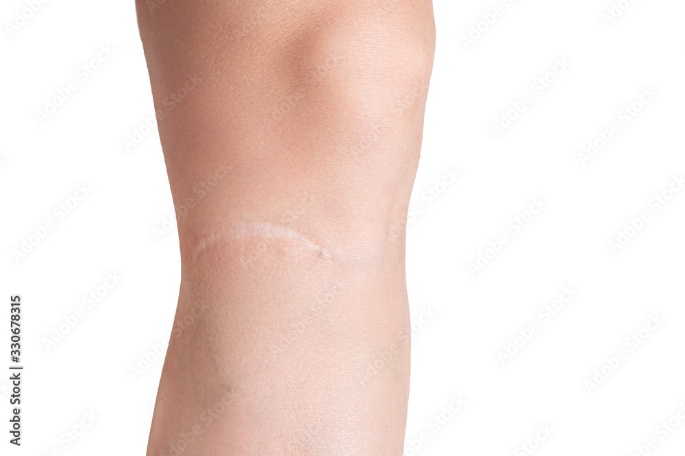 Scar on a girl's leg close-up. Varicose veins from the injury on the ...