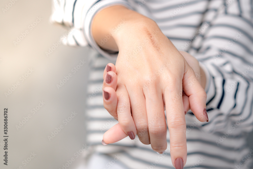 Close up: Hands of a woman with first degree heat burn scar about a ...