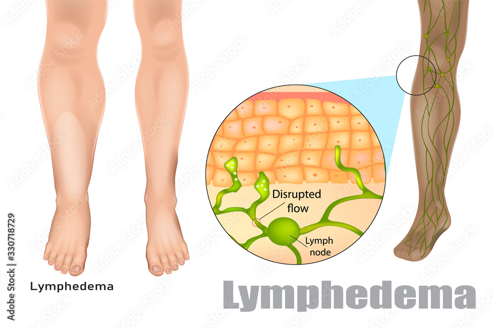 Lymphedema, also known as lymphoedema and lymphatic edema Stock Vector ...