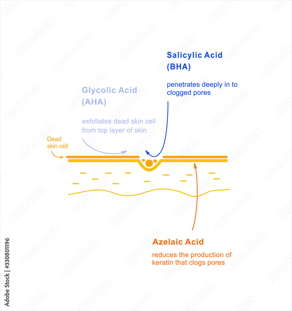 Infographics acid exposure on skin. Skin care exfoliating. Salicylic ...