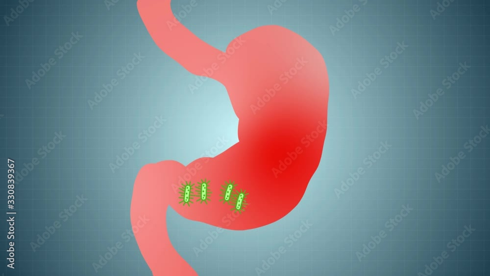 Painted stomach with bacteria, viruses. Poisoning of the stomach ...