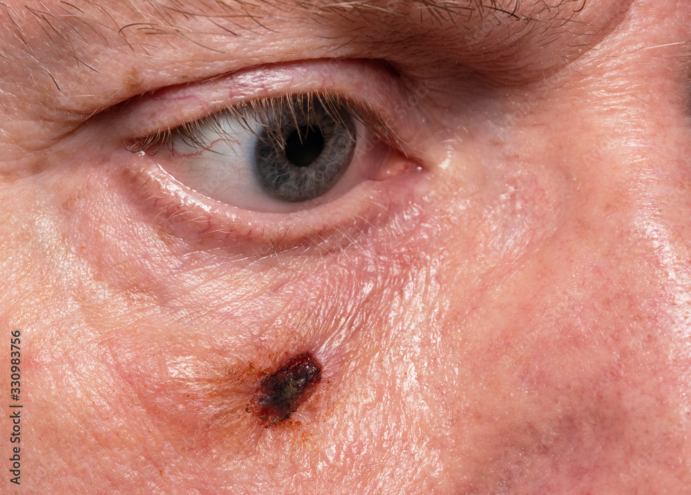 Wound on causian male cheek after removal of suspected skin cancer spot ...