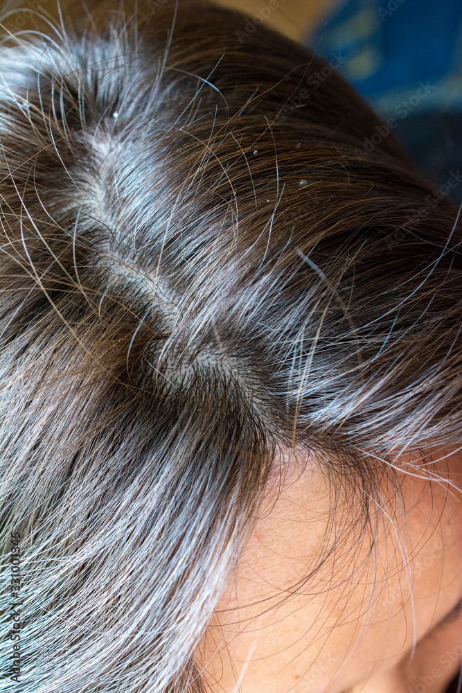 Dandruff seborrhea problem of scalp and hair treatment of peeling from ...