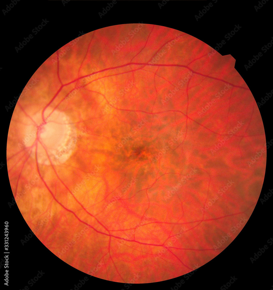 Ophthalmic image detailing the retina and optic nerve inside a healthy ...
