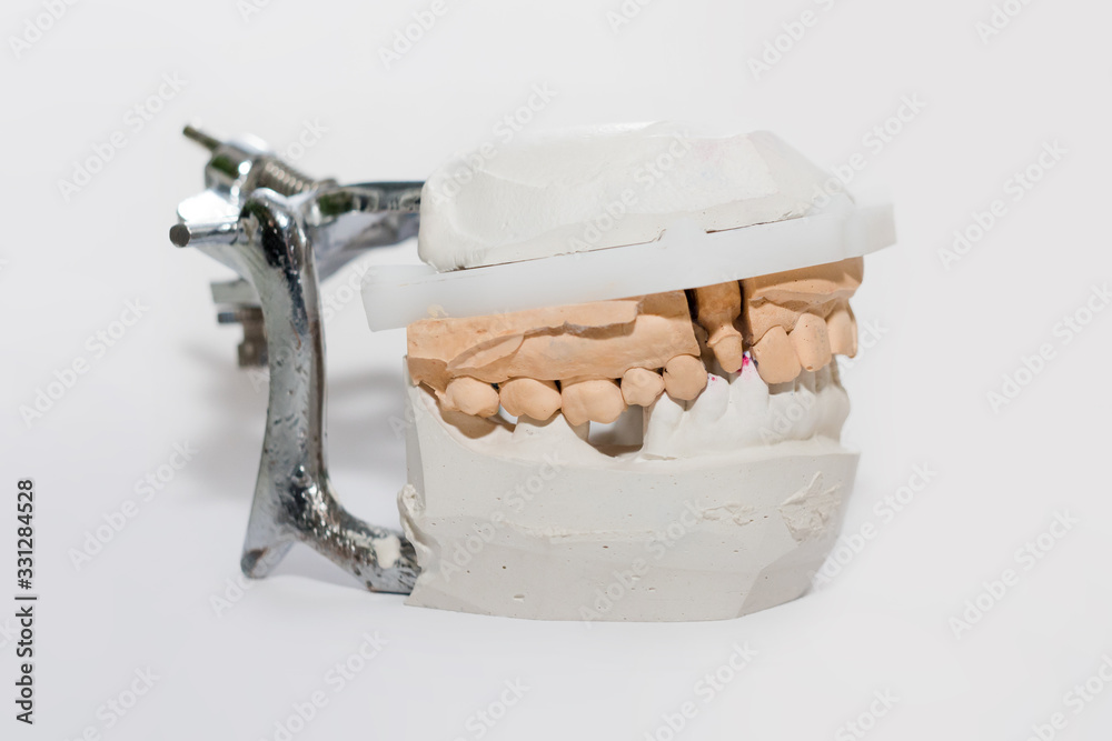 Foto de Plaster Cast of jaws. Dental casting gypsum model human Jaws in ...